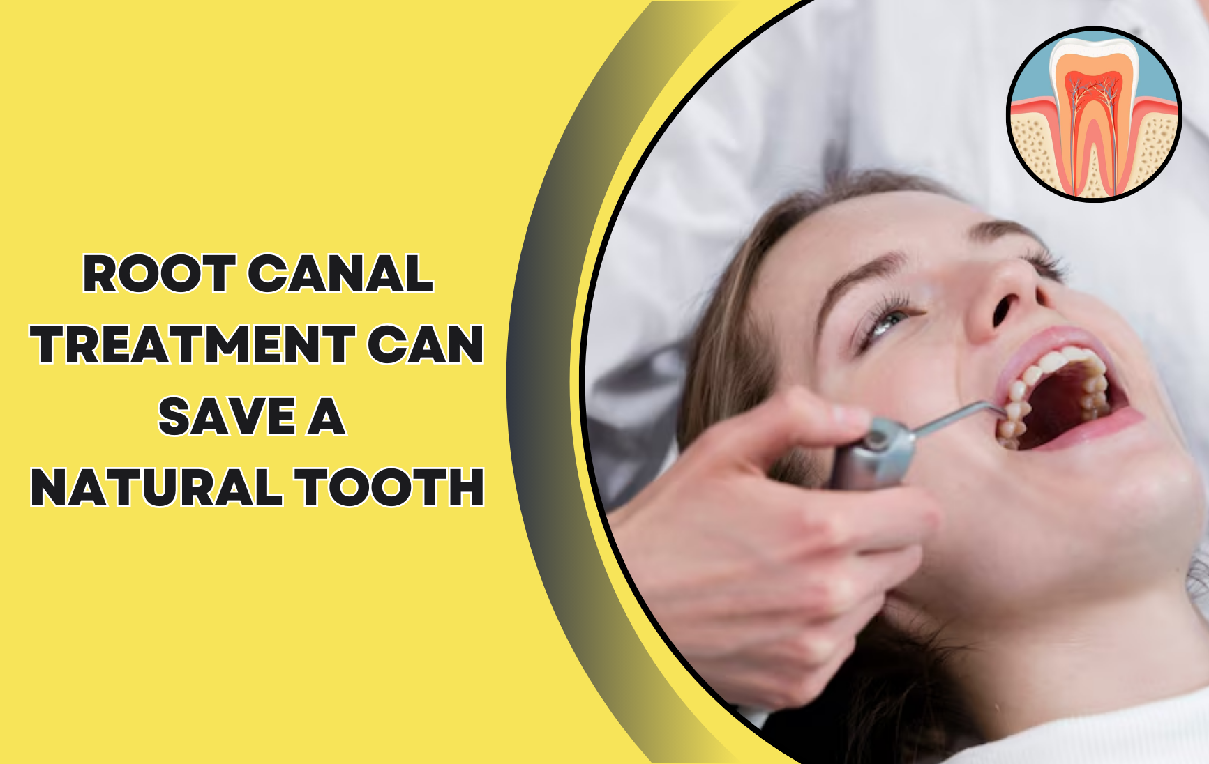 Benefits of Root Canal Treatment for Saving Natural Teeth